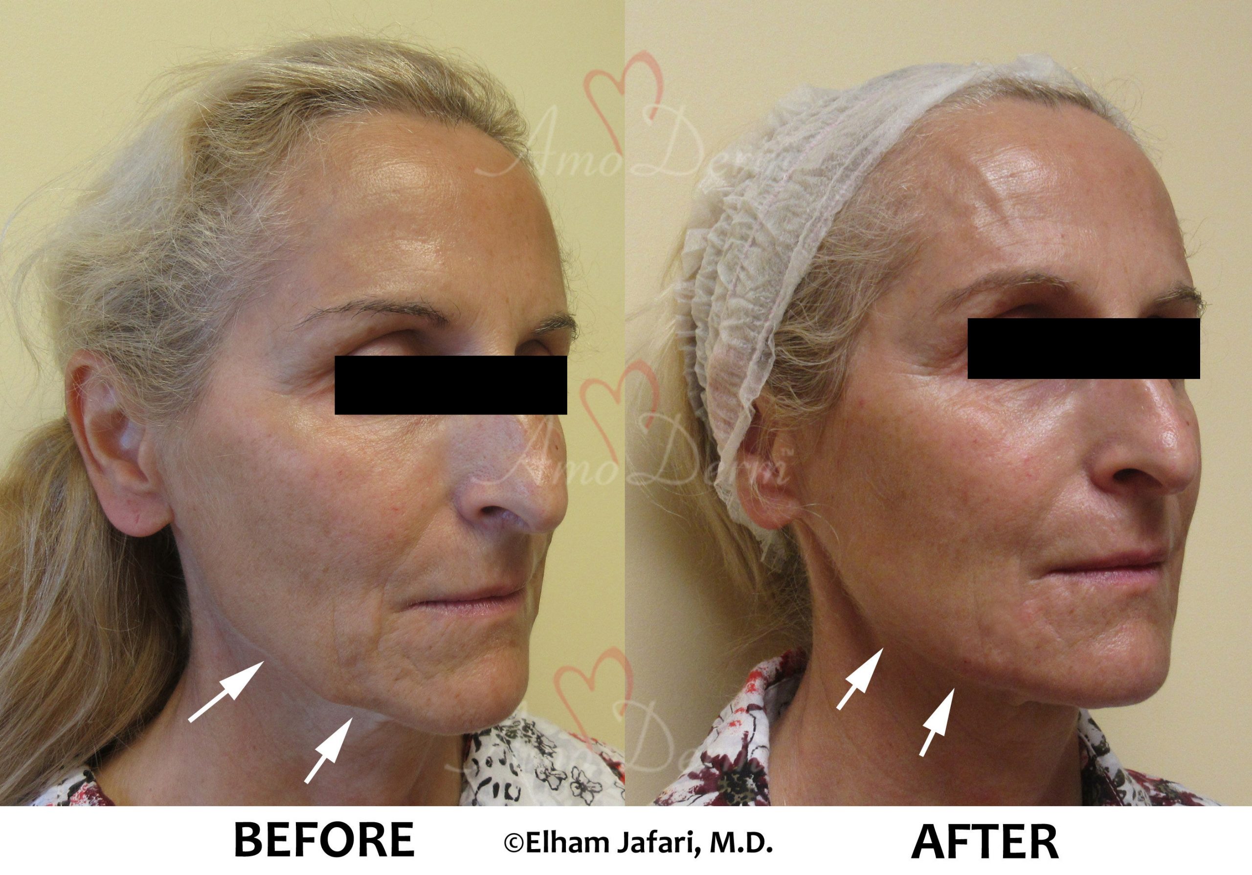 Liquid Facelift Cosmetic Treatments Before and After Pictures