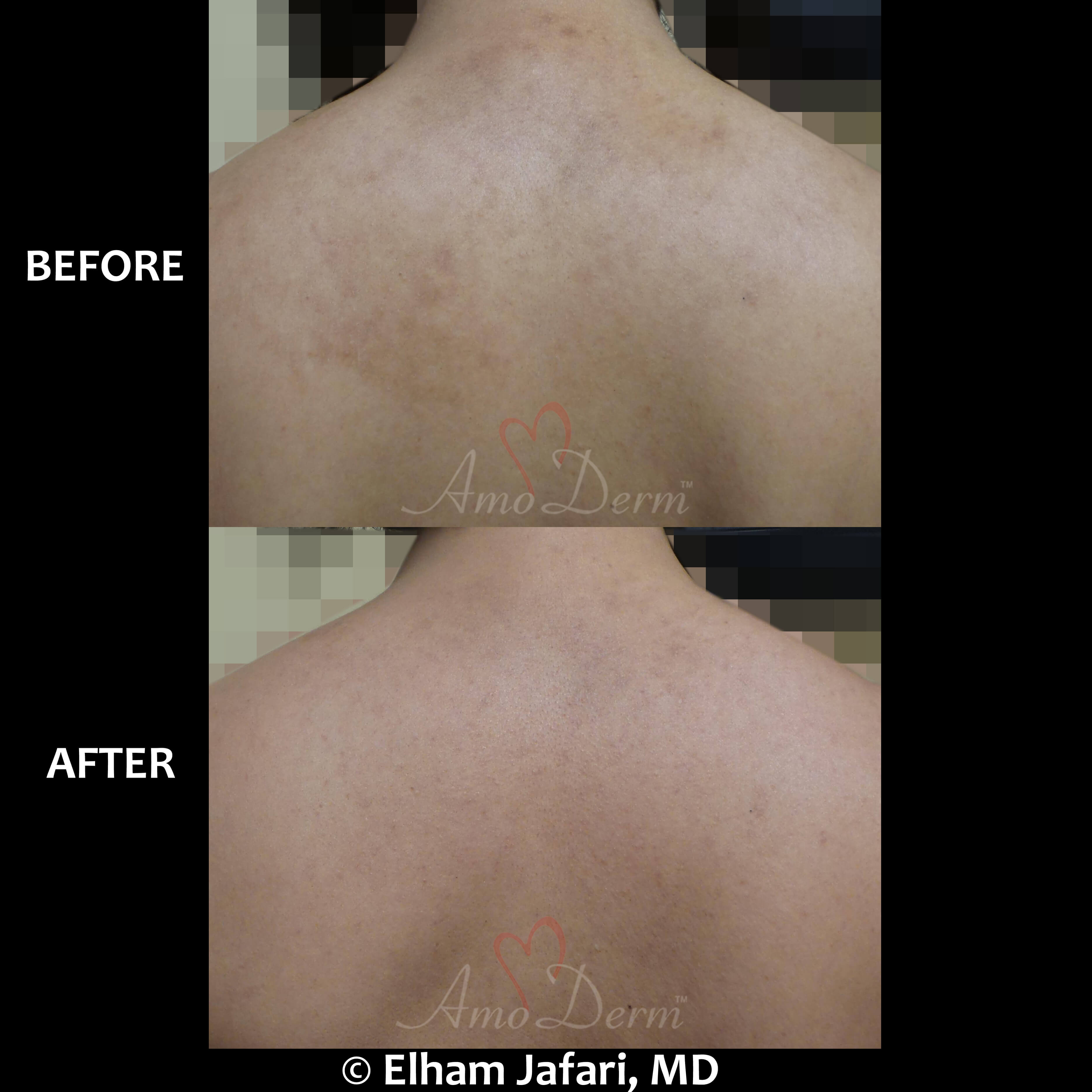 Orange County MicroLaser Peel and Laser Skin Resurfacing