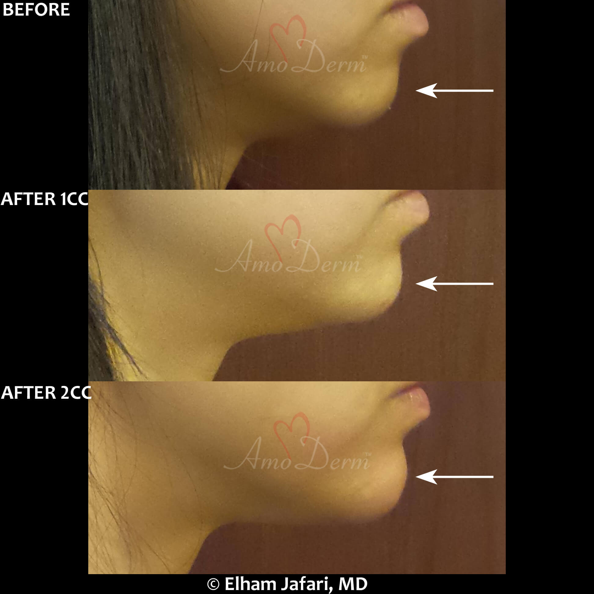 Irvine & Newport Beach Juvederm Voluma - Orange County Fillers
