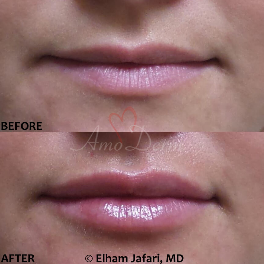 Lip Augmentation Irvine - Lip Injections, Lip Fillers, Orange County