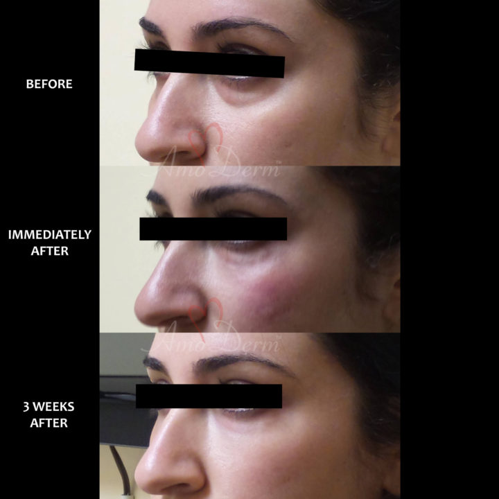 4D Under Eye Lift to treat dark circles under eyes & contour cheeks