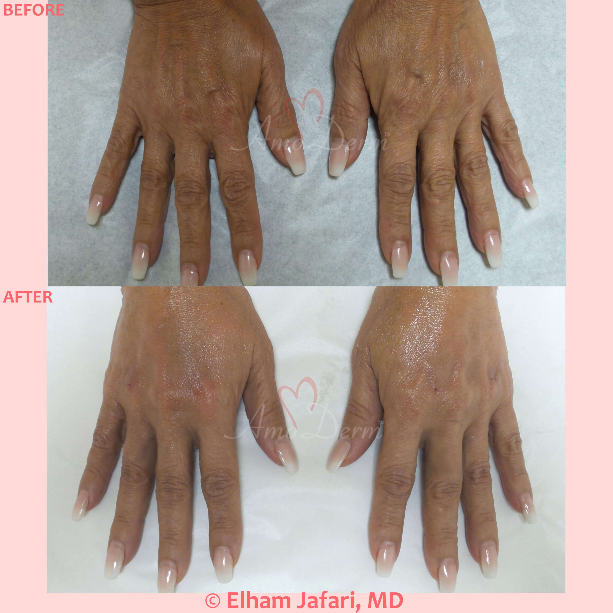Irvine & Newport Beach Hand Rejuvenation - Orange County Fillers
