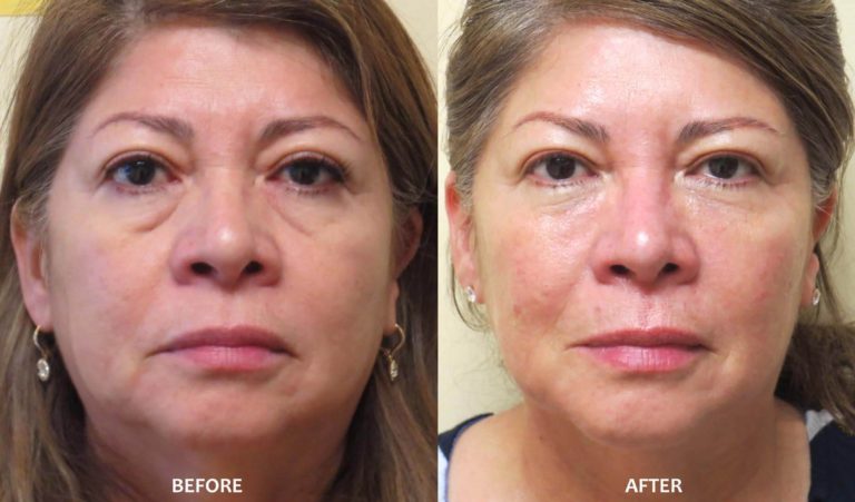 4D Under Eye Lift to treat dark circles under eyes & contour cheeks