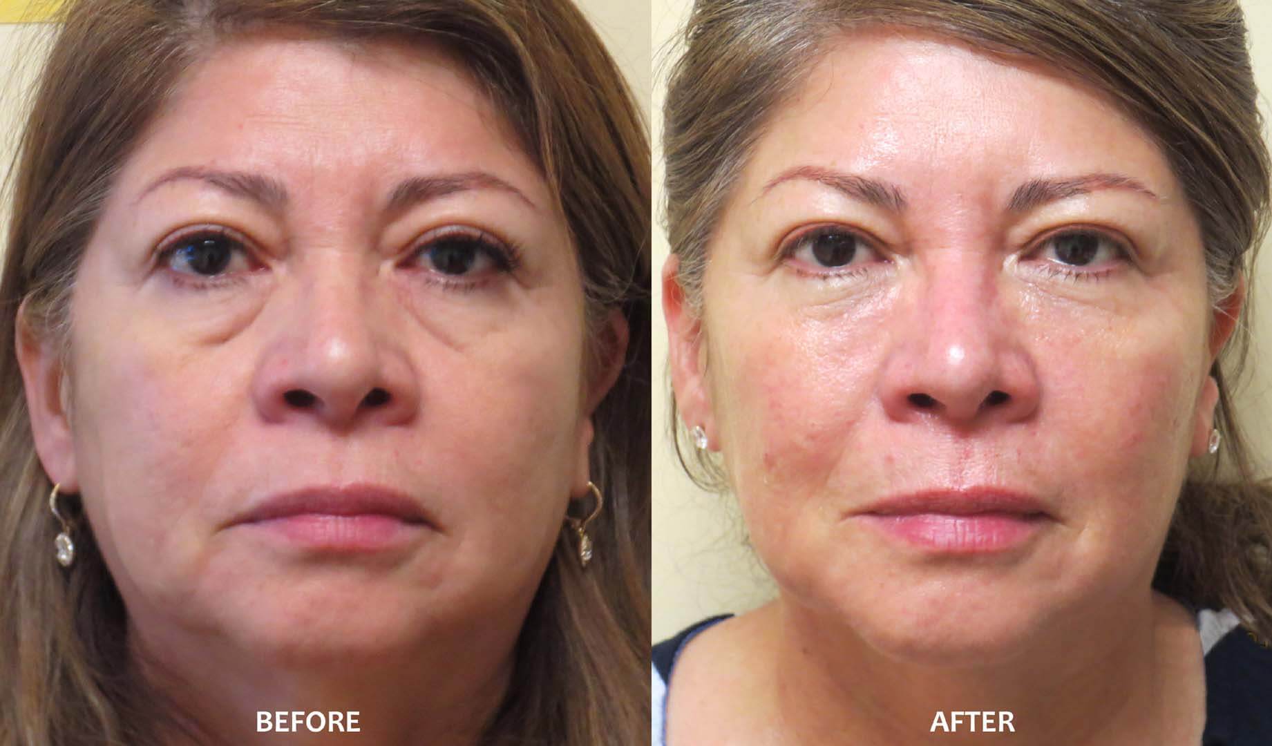 4D Under Eye Lift to treat dark circles under eyes & contour cheeks