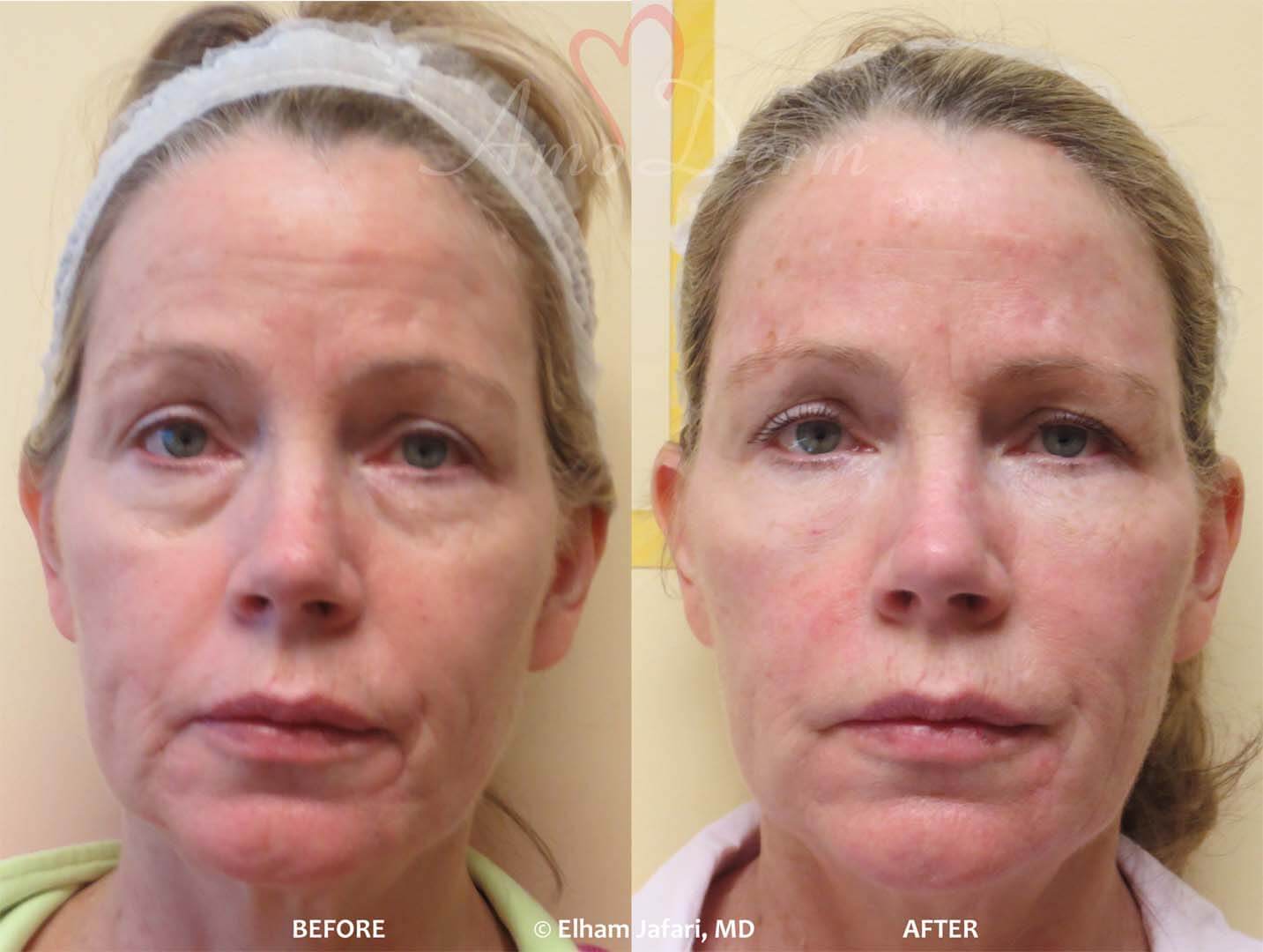 4D Under Eye Lift to treat dark circles under eyes & contour cheeks