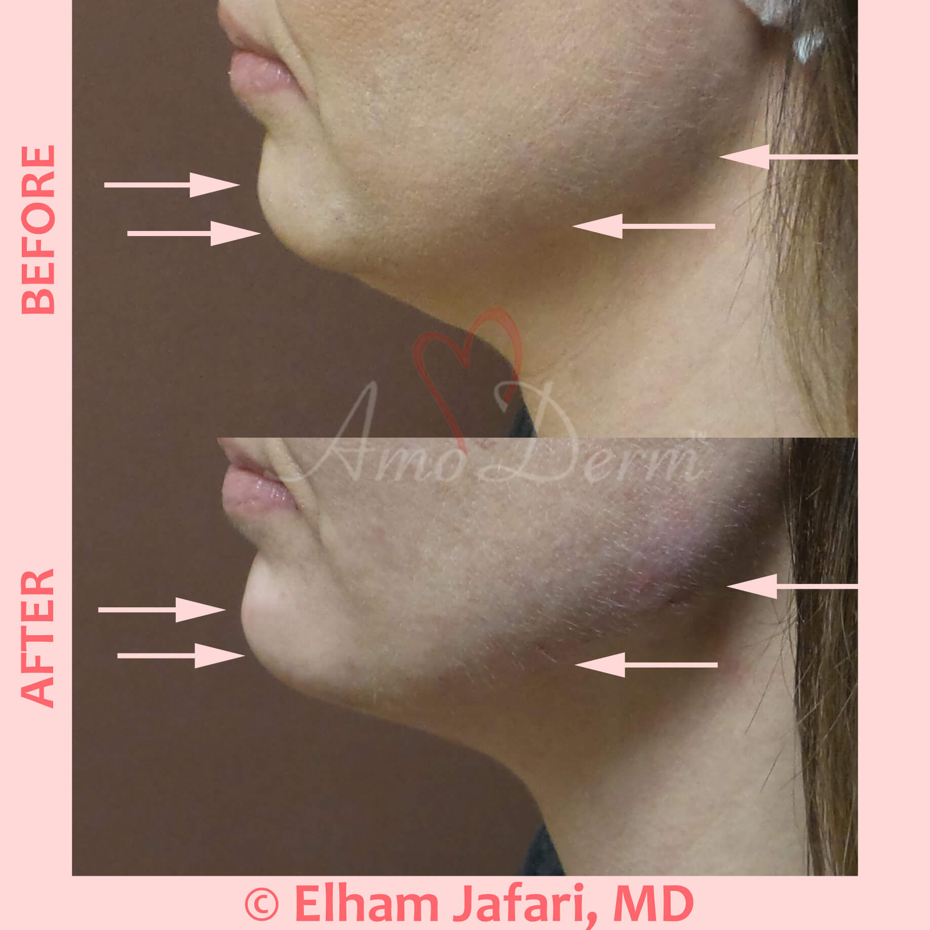 Bellafill (Artefill), the Beauty that Lasts - Collagen Injection in OC