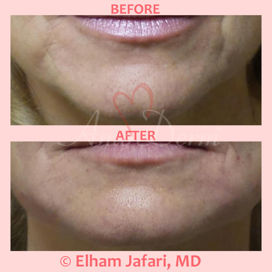 Marionette Lines - Common Concerns