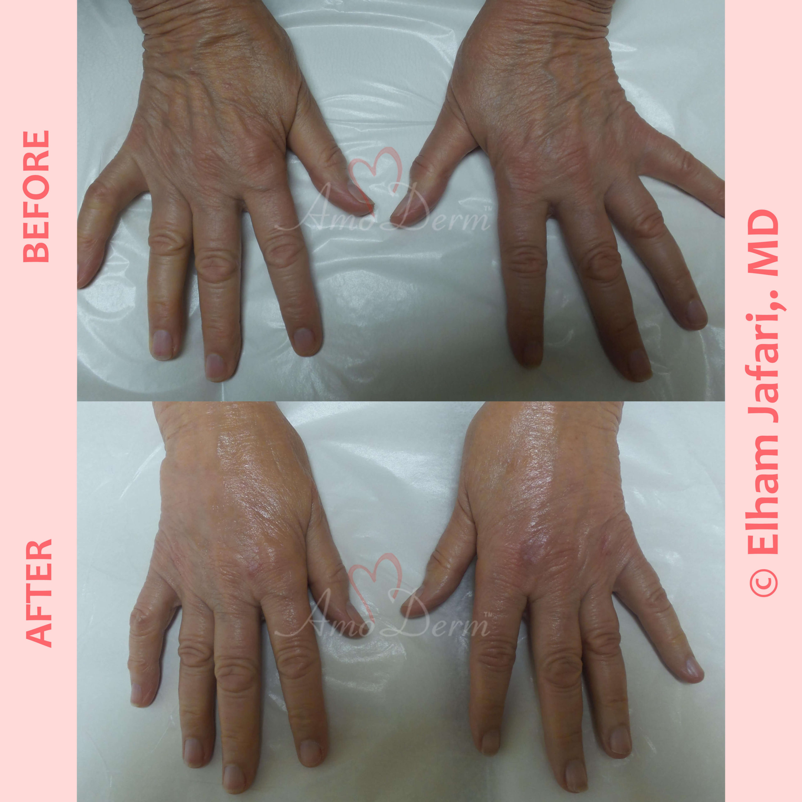 Irvine & Newport Beach Hand Rejuvenation - Orange County Fillers