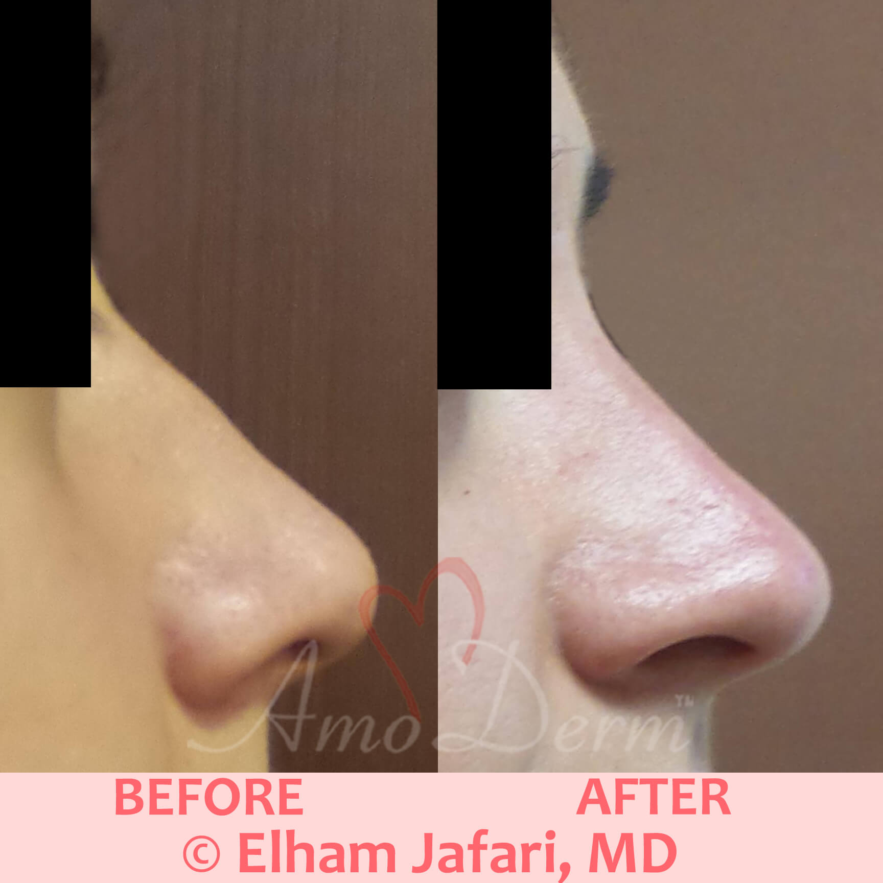 Non-surgical Nose Job (Liquid Rhinoplasty) by Dr Jafari in Irvine