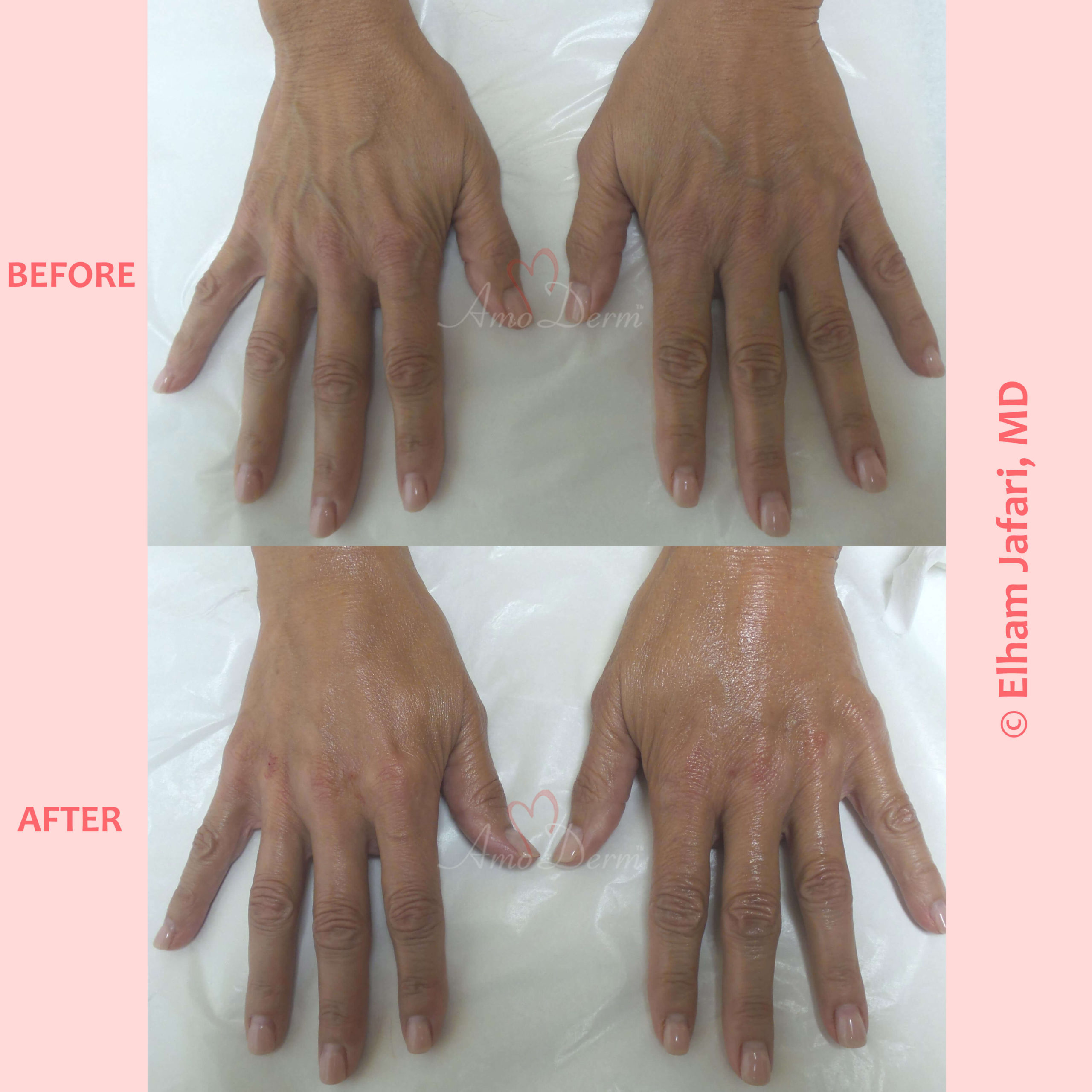 Irvine & Newport Beach Hand Rejuvenation - Orange County Fillers