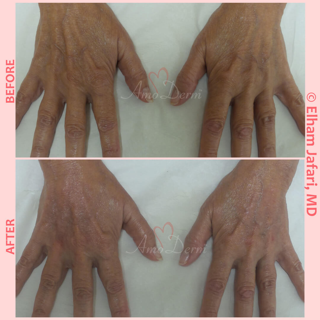 Irvine & Newport Beach Hand Rejuvenation - Orange County Fillers