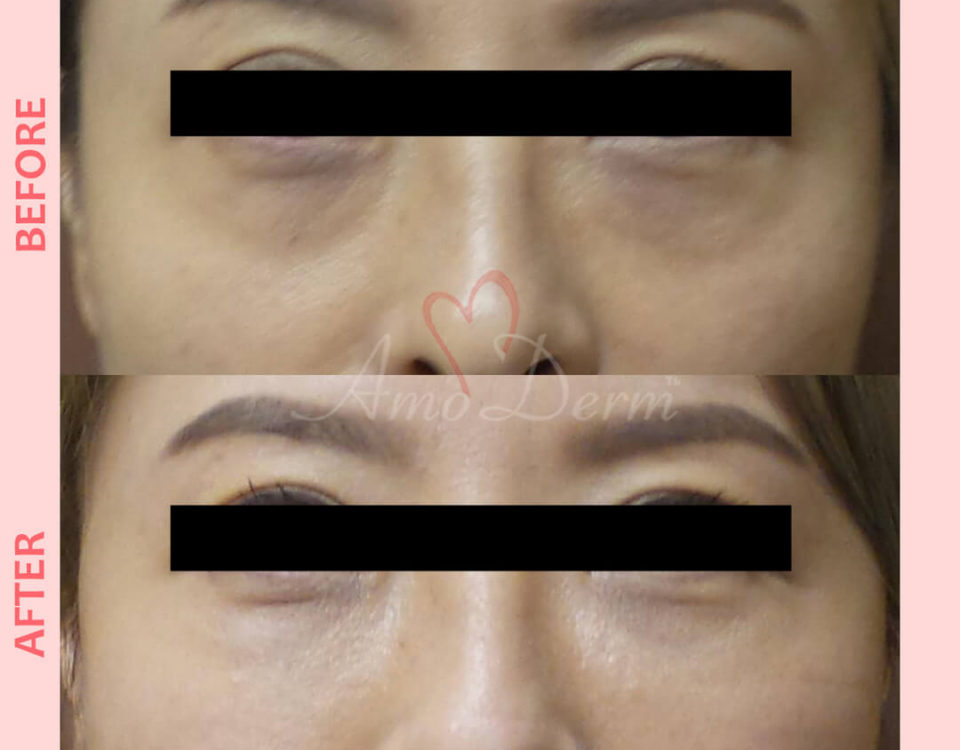4D Under Eye Lift to treat dark circles under eyes & contour cheeks