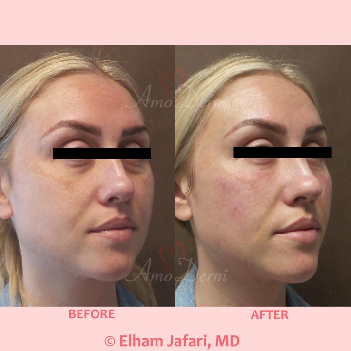 Microcannula - a new way less painful for filler injections