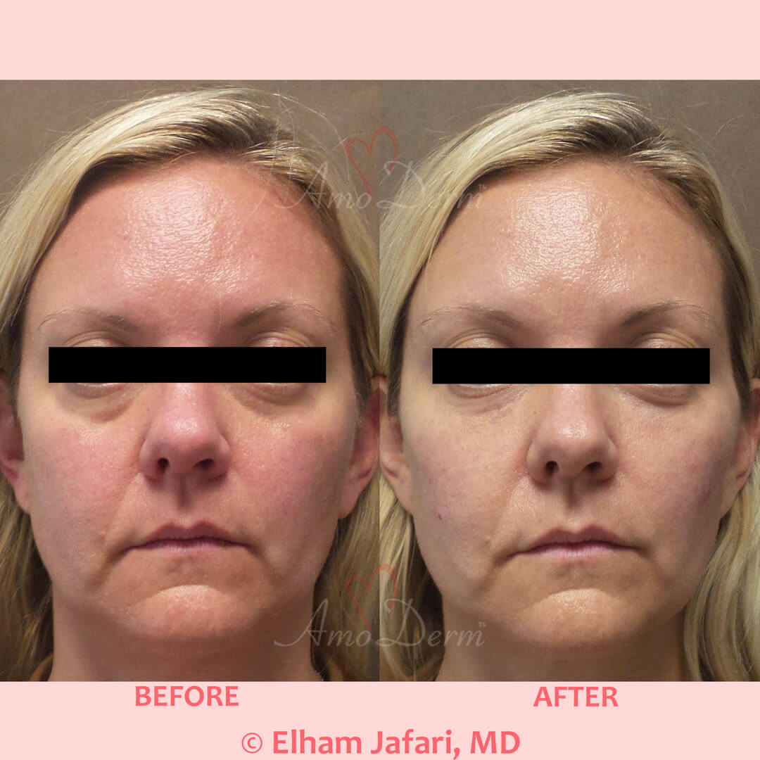 Liquid Facelift - Cosmetic Treatments in Irvine, Orange County