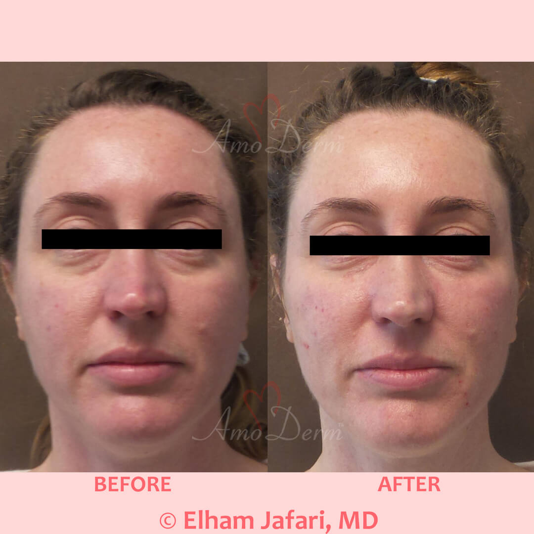 Microcannula - a new way less painful for filler injections