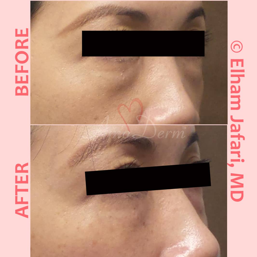 Liquid Facelift - Cosmetic Treatments in Irvine, Orange County