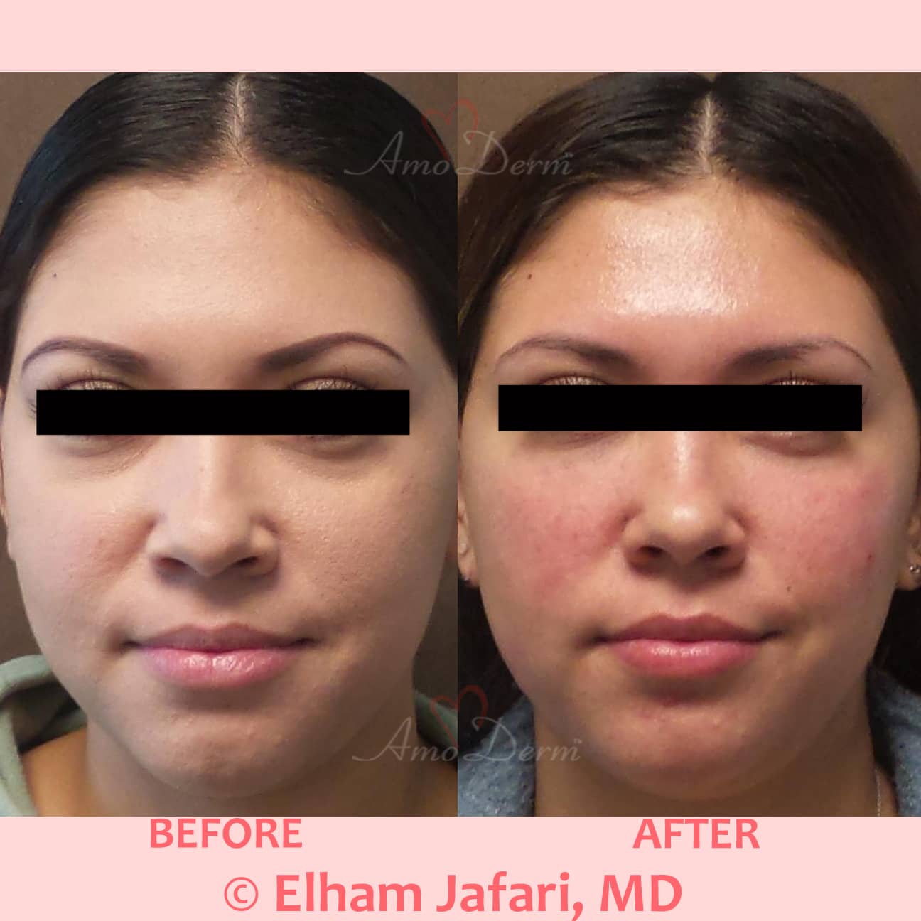Liquid Facelift - Cosmetic Treatments in Irvine, Orange County