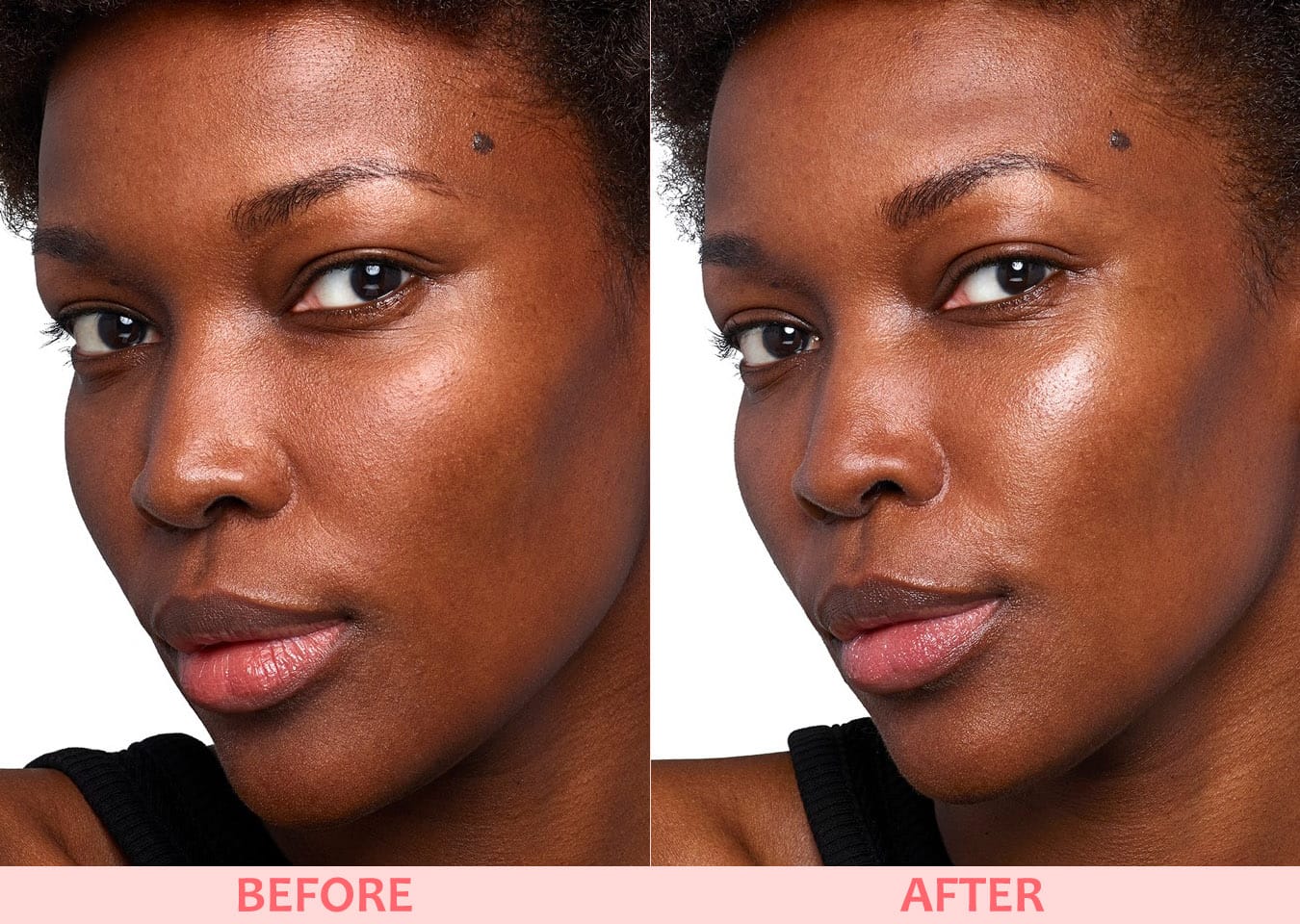 SkinVive by Juvederm in Irvine & Newport Beach- Orange County