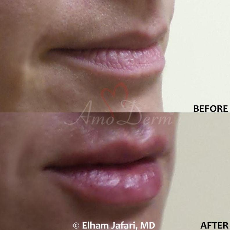 Lip Augmentation Irvine - Lip Injections, Lip Fillers, Orange County