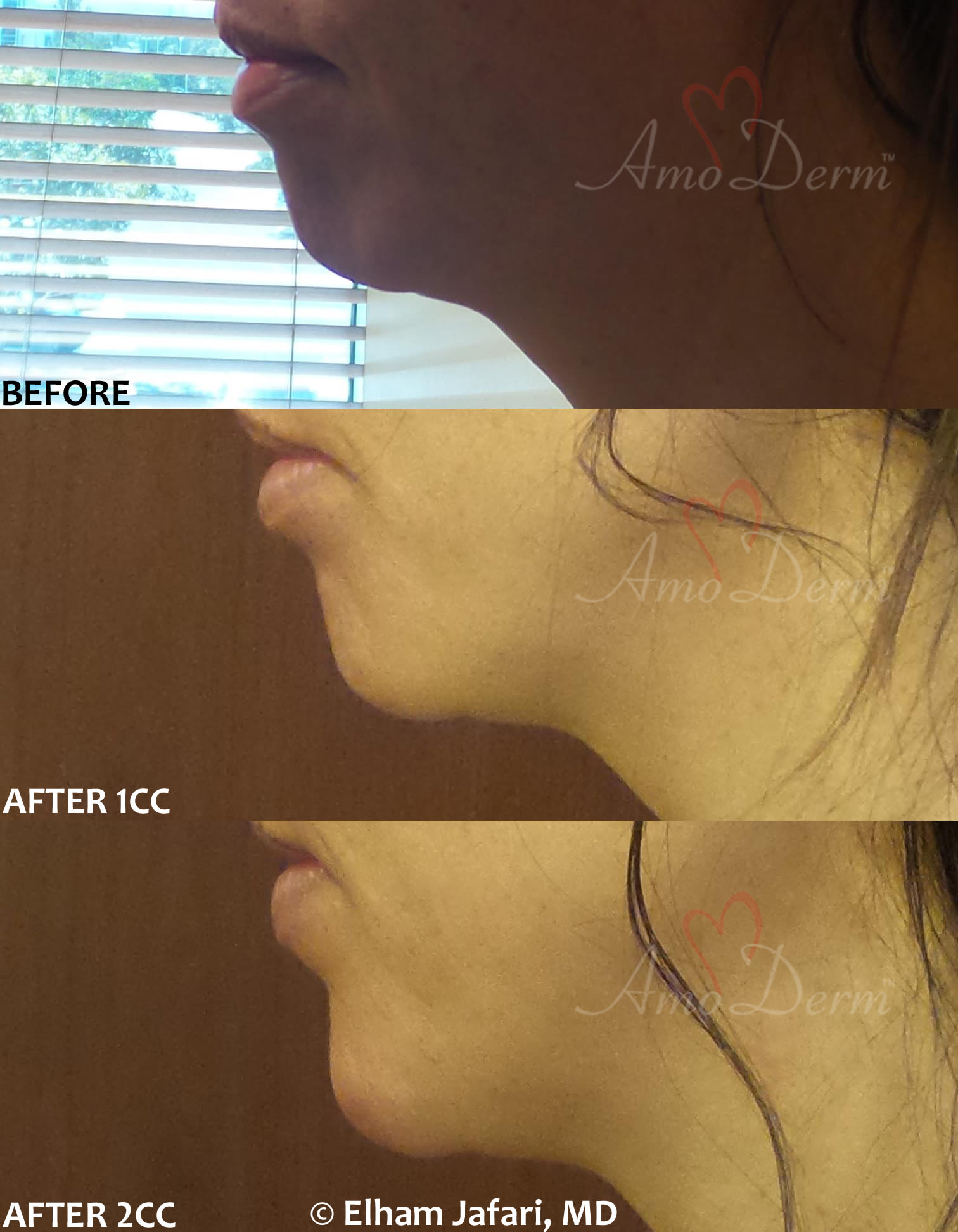 Bellafill (Artefill), the Beauty that Lasts - Collagen Injection in OC