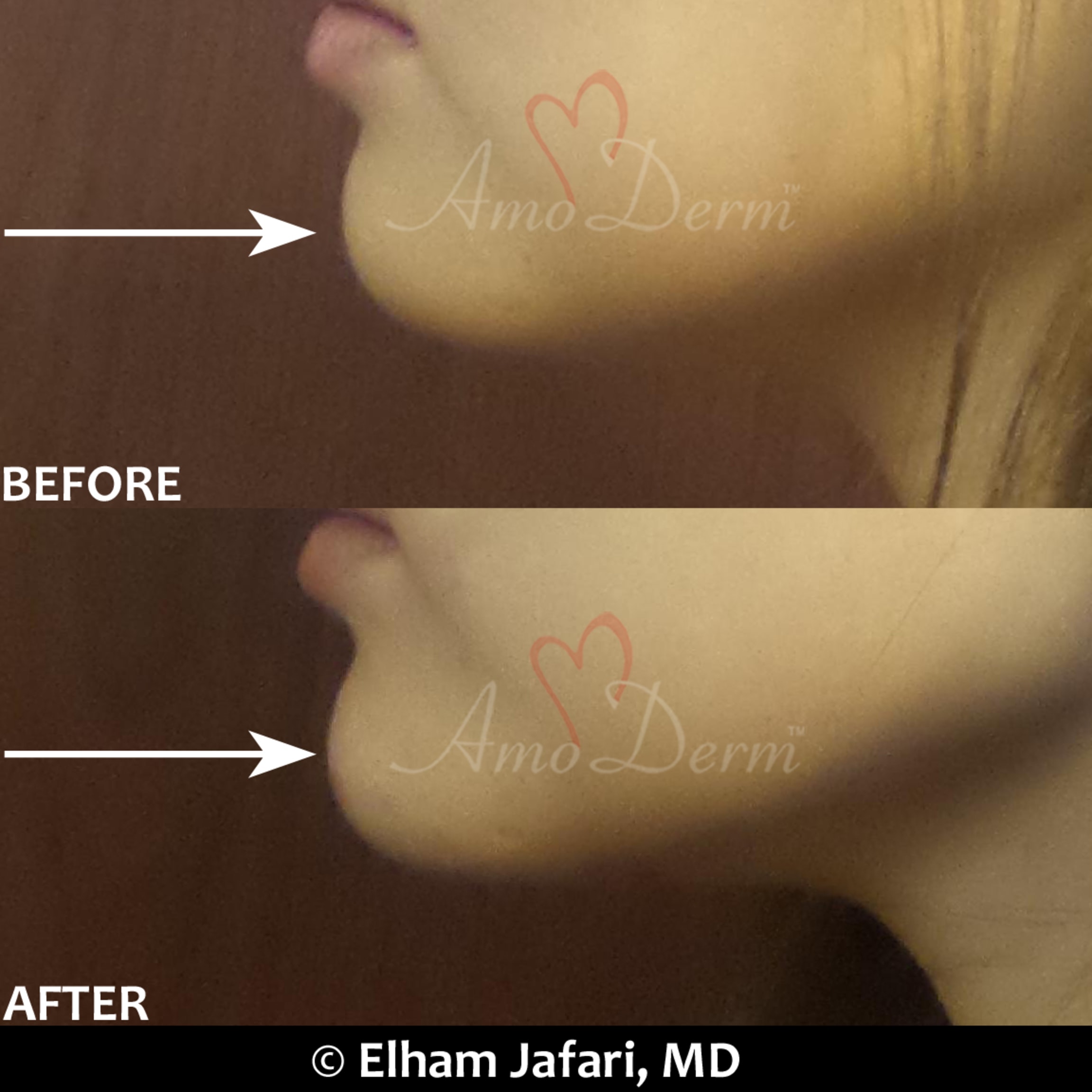 Bellafill (Artefill), the Beauty that Lasts - Collagen Injection in OC