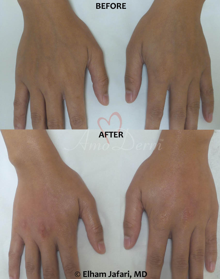 Irvine & Newport Beach Hand Rejuvenation - Orange County Fillers