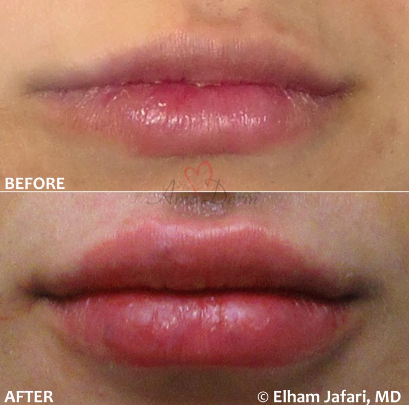 Lip Augmentation Irvine - Lip Injections, Lip Fillers, Orange County