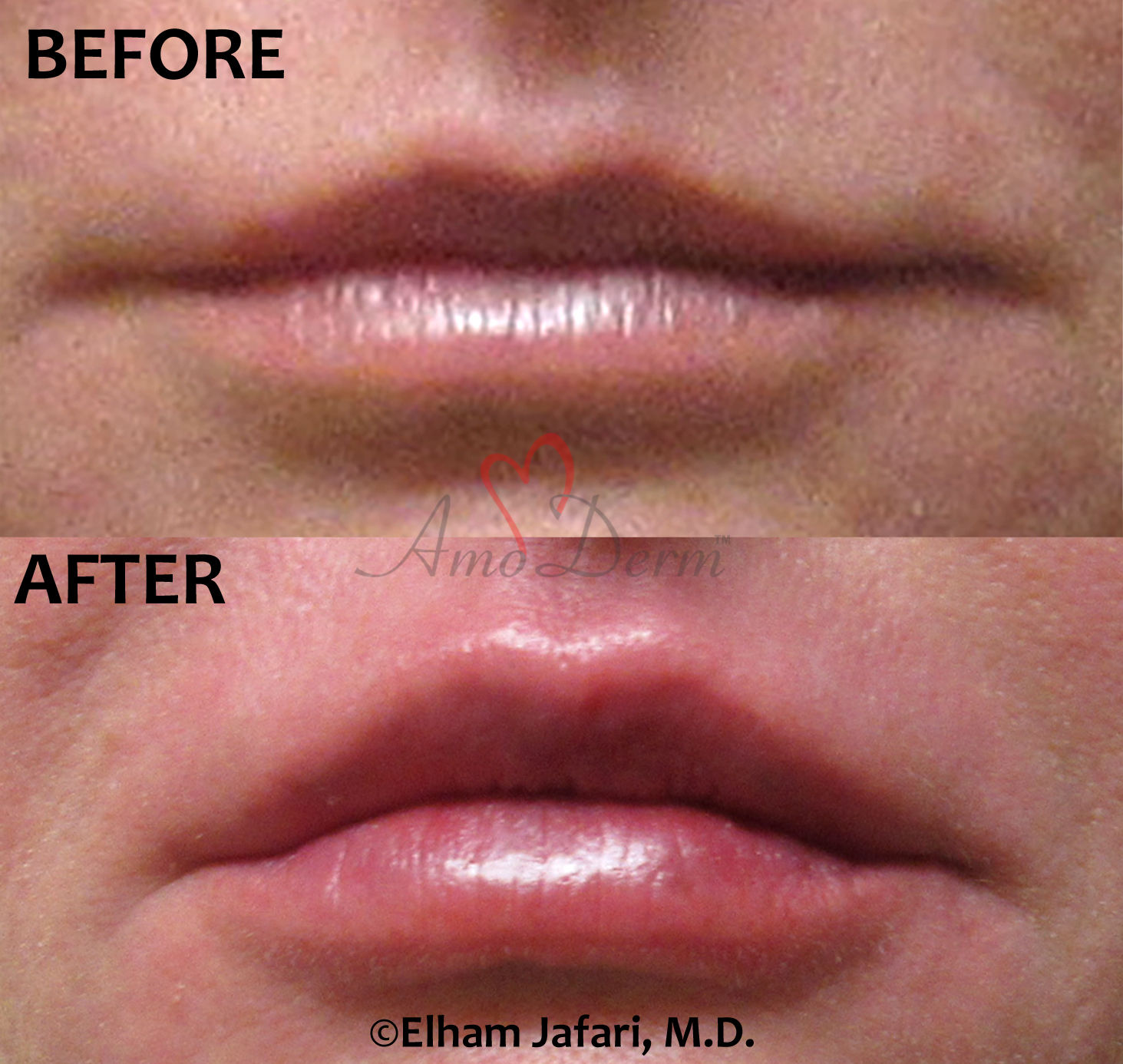 Lip Augmentation Irvine - Lip Injections, Lip Fillers, Orange County