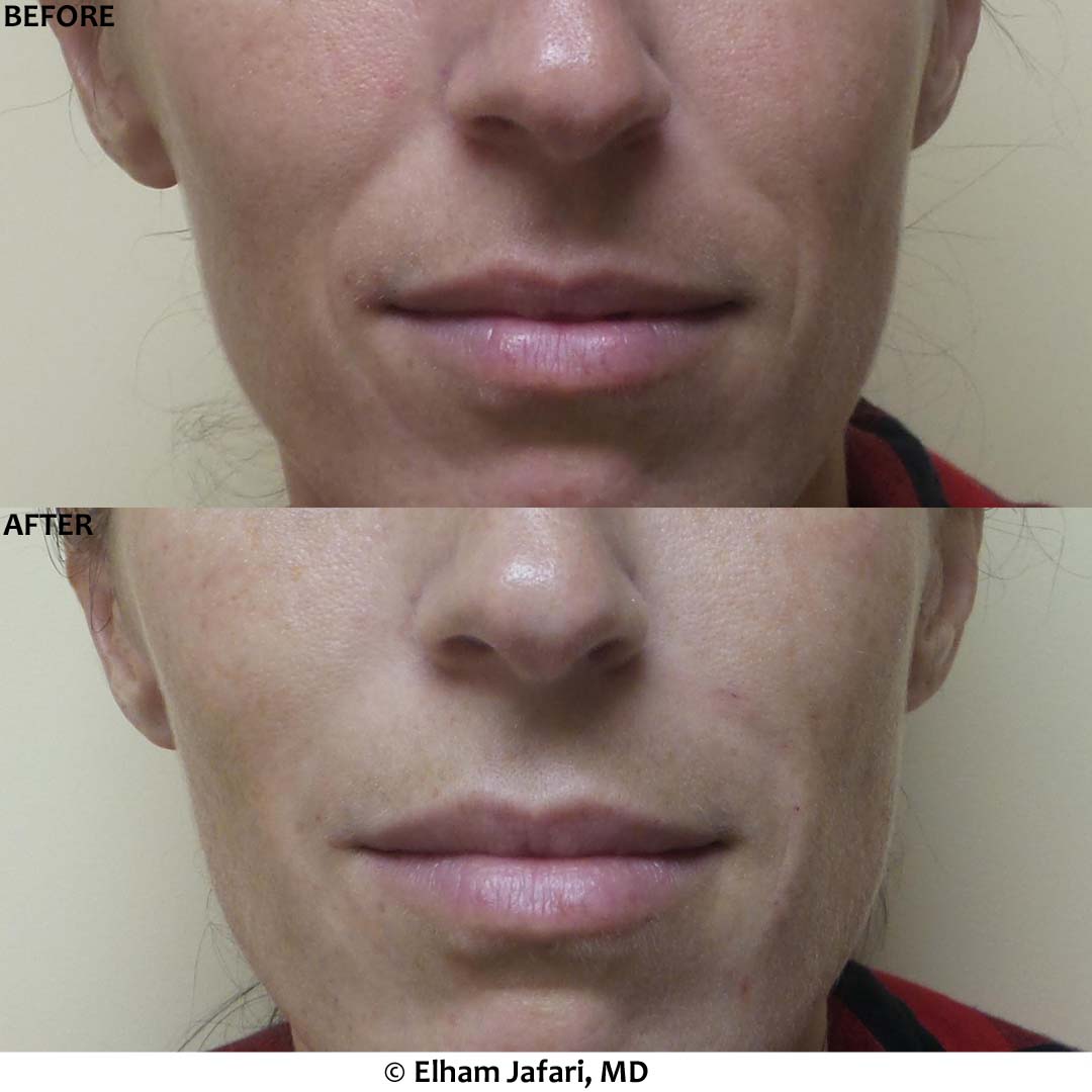 Nasolabial Folds - Common Concerns known as smile lines or laugh lines