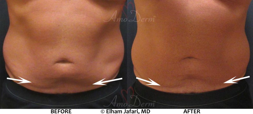 SculpSure | Non-Surgical Body Contouring Treatments in Irvine