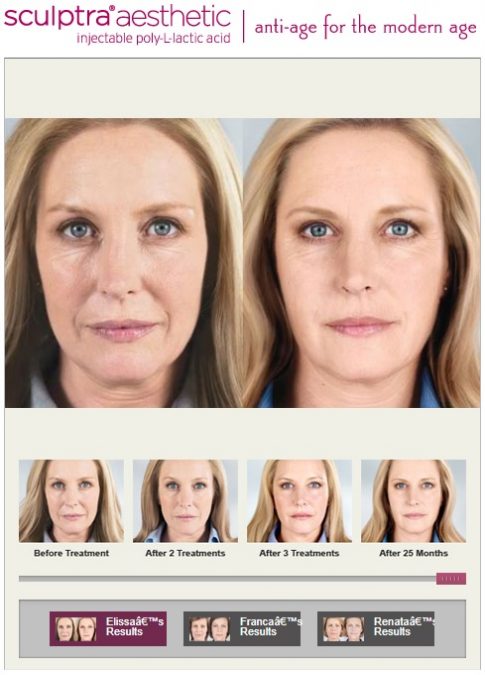 Orange County Sculptra - Irvine Sculptra Dermal Filler by Doctor