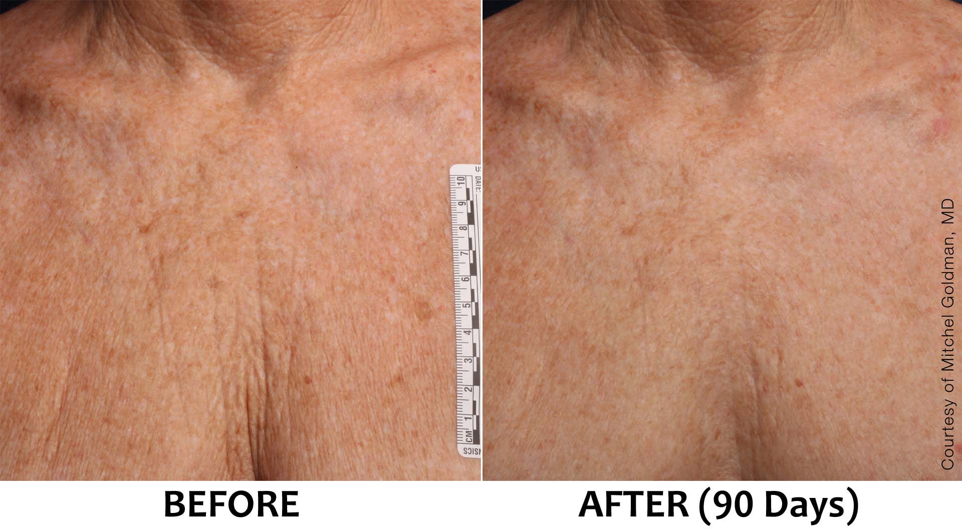 Ultherapy Decolletage Wrinkles Lines Chest