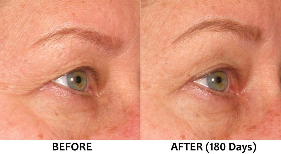 Ultherapy: Skin rejuvenation & tightening in Irvine, Newport Beach, OC