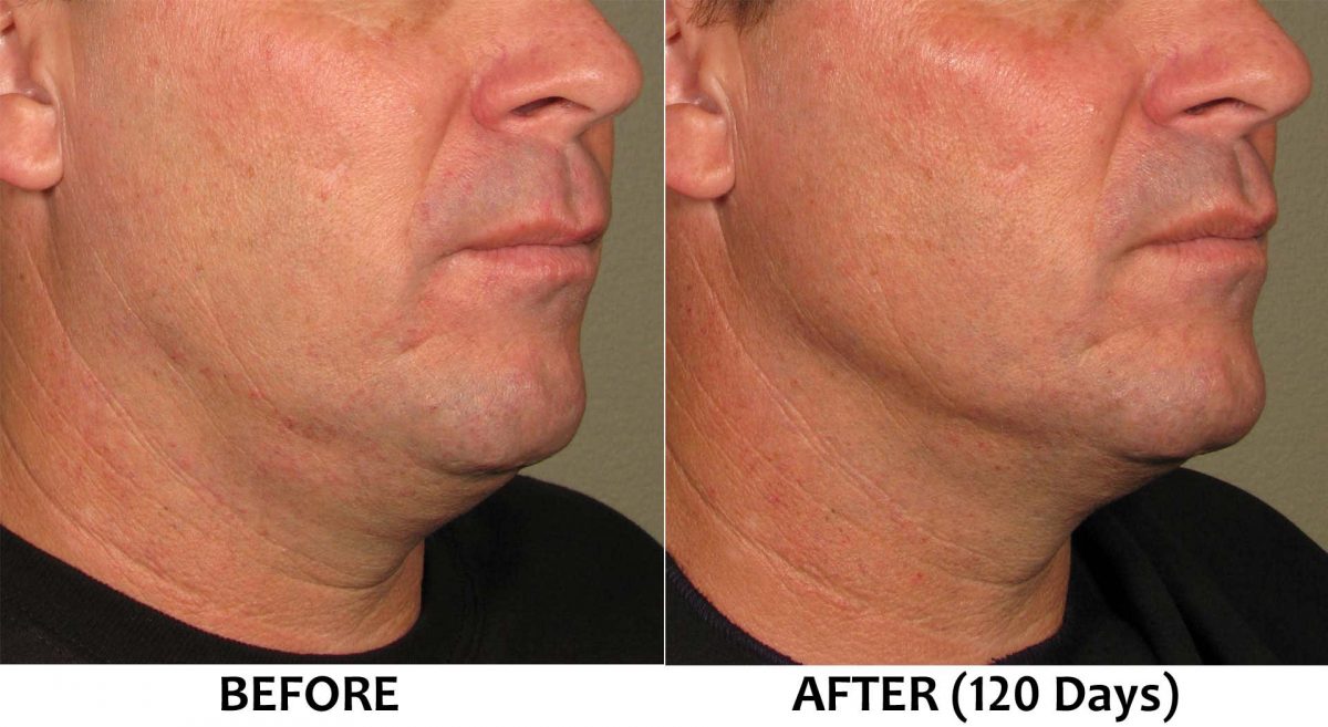 Ultherapy: Skin rejuvenation & tightening in Irvine, Newport Beach, OC