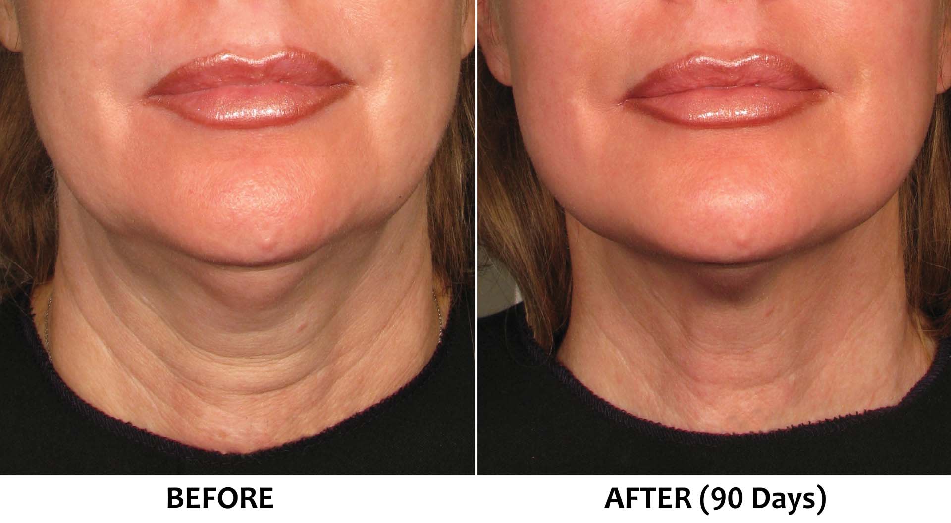 Ultherapy: Skin rejuvenation & tightening in Irvine, Newport Beach, OC